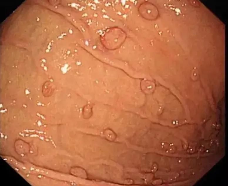 Clinic Story--Tangled Stomach and Colon Polyps - iNEWS
