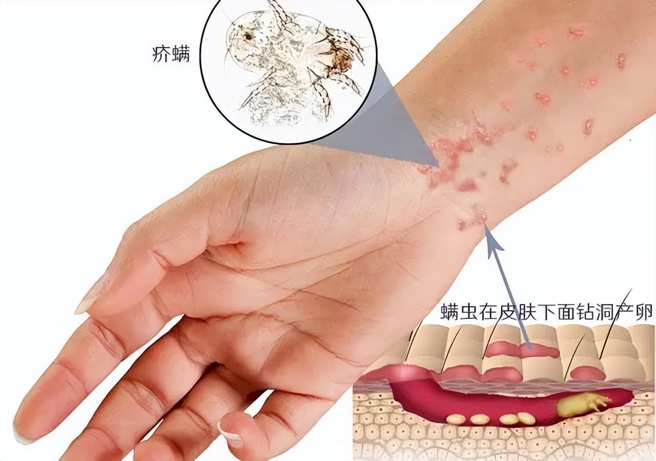 A family with generalized eczema turned out to be caused by scabies - iNEWS