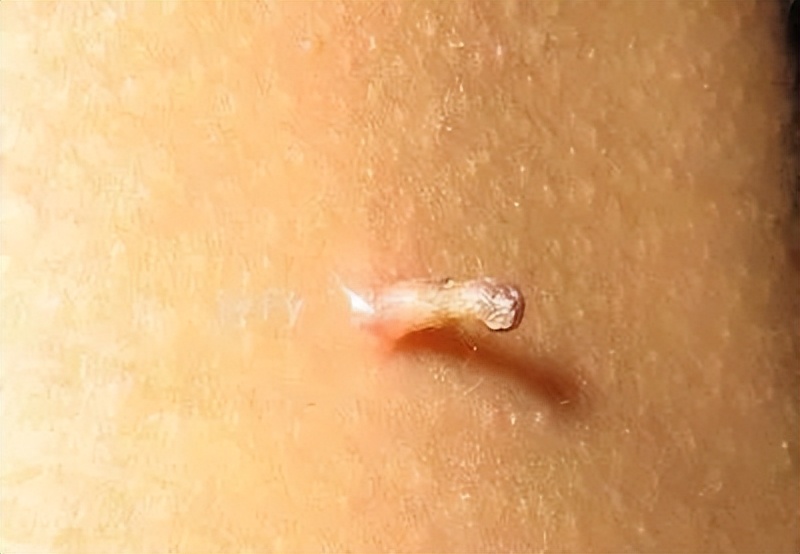 "10-year-old boy infected with hpv in swimming class", doctors ...