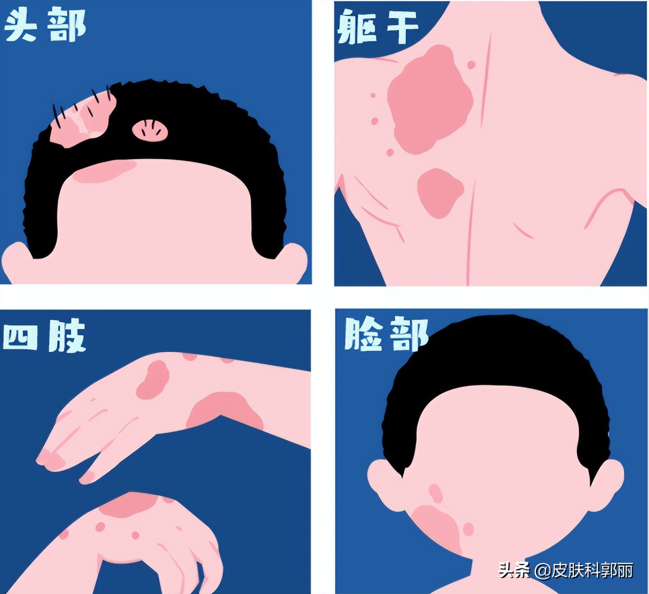 Take you to understand erythrodermic psoriasis - iNEWS