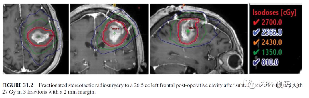 "Notes" Stereotactic Radiosurgery for 1 to 5 Brain Metastases - iNEWS