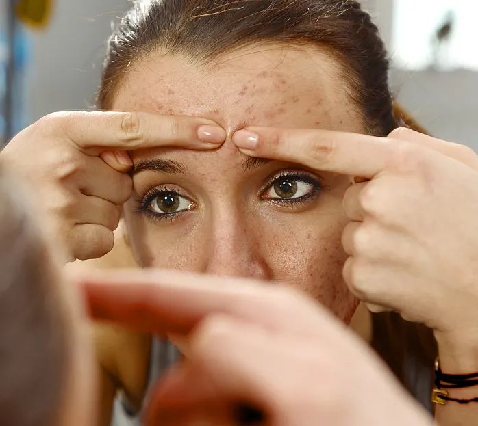 Why your forehead grows closed and pimples - iNEWS