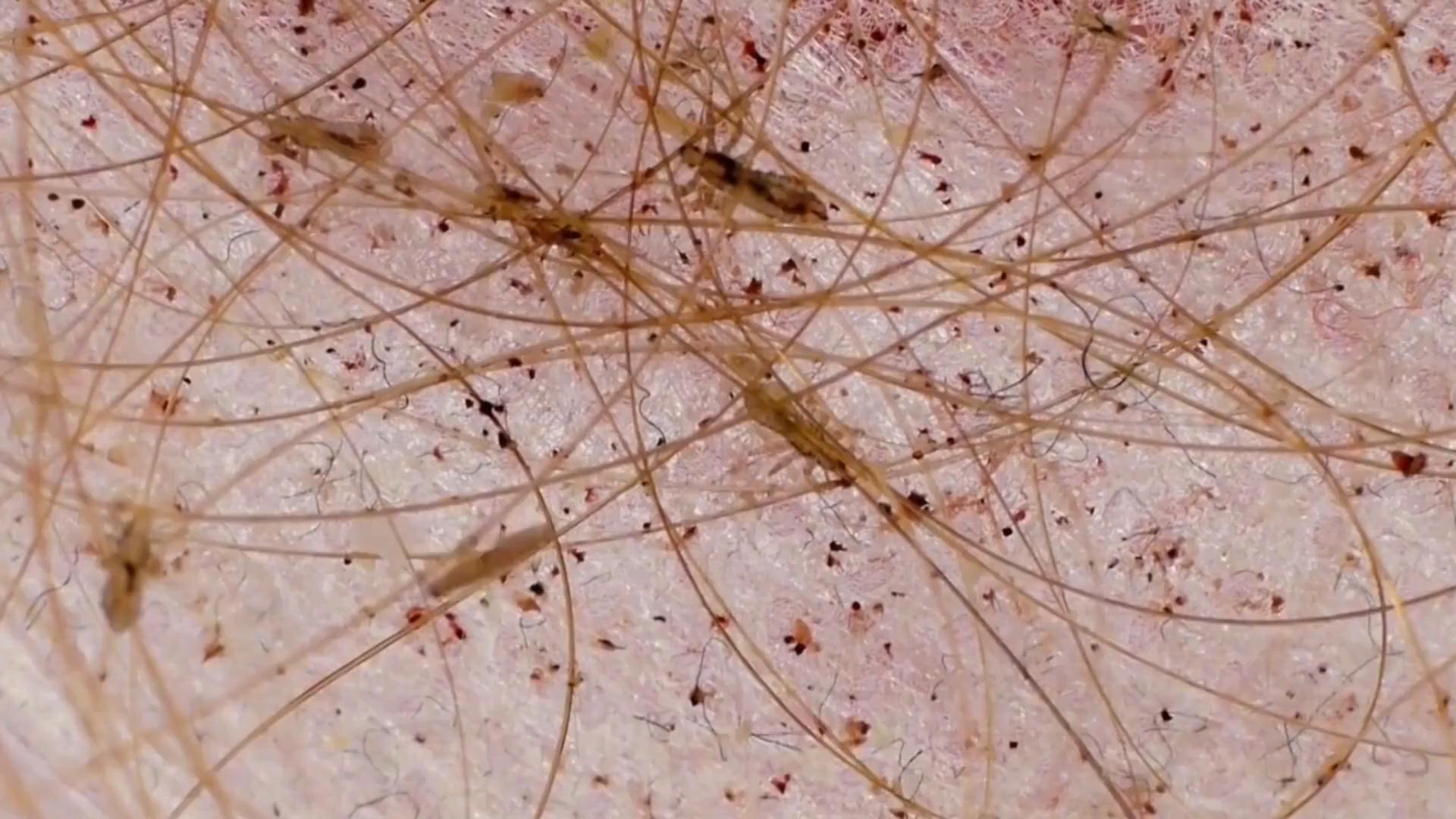 Lice that used to be common but are now hard to see? What are the ...