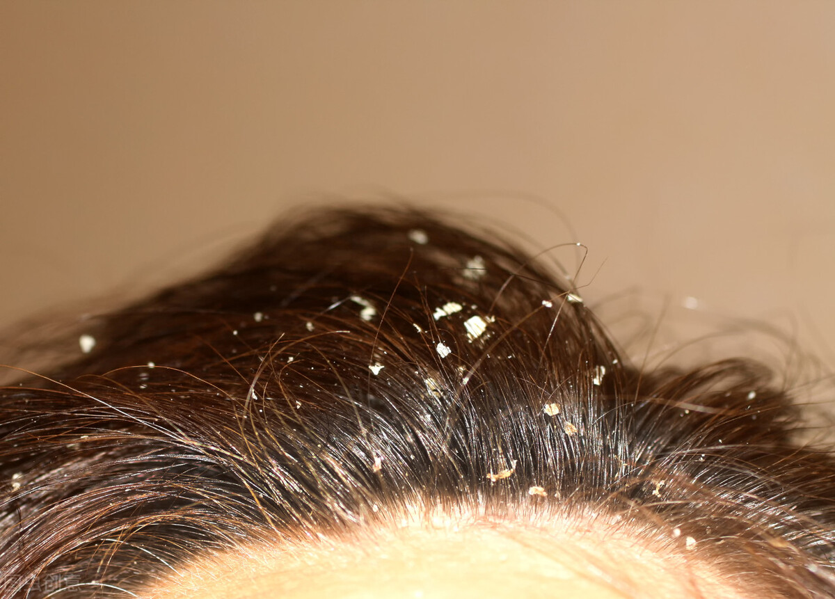 The dandruff is like snowflakes and the scalp is very greasy, don't ...