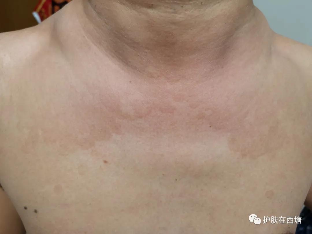 sweat spots and pityriasis versicolor - iNEWS