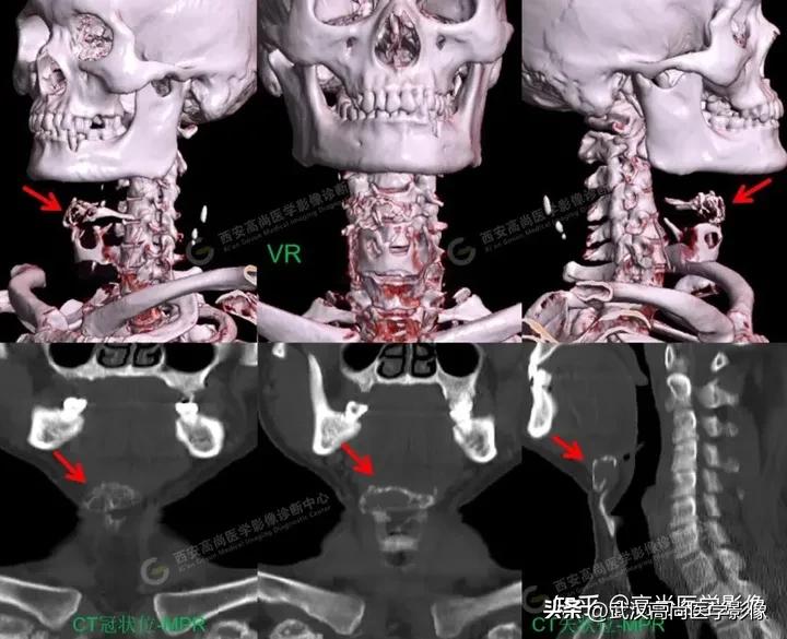 Glomus hyoid tumor (round cell tumor) "Wuhan Gaoshang Medical Imaging ...