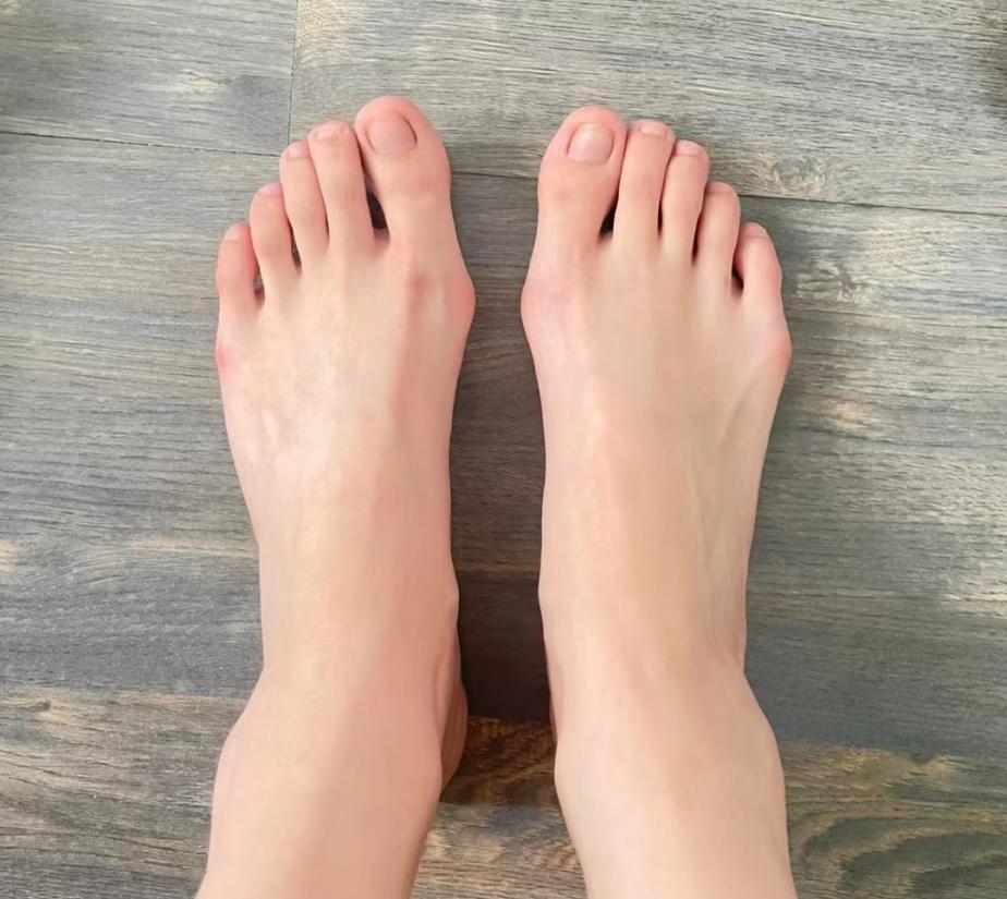 Toe swelling and pain, hallux valgus treatment should be "as soon as ...