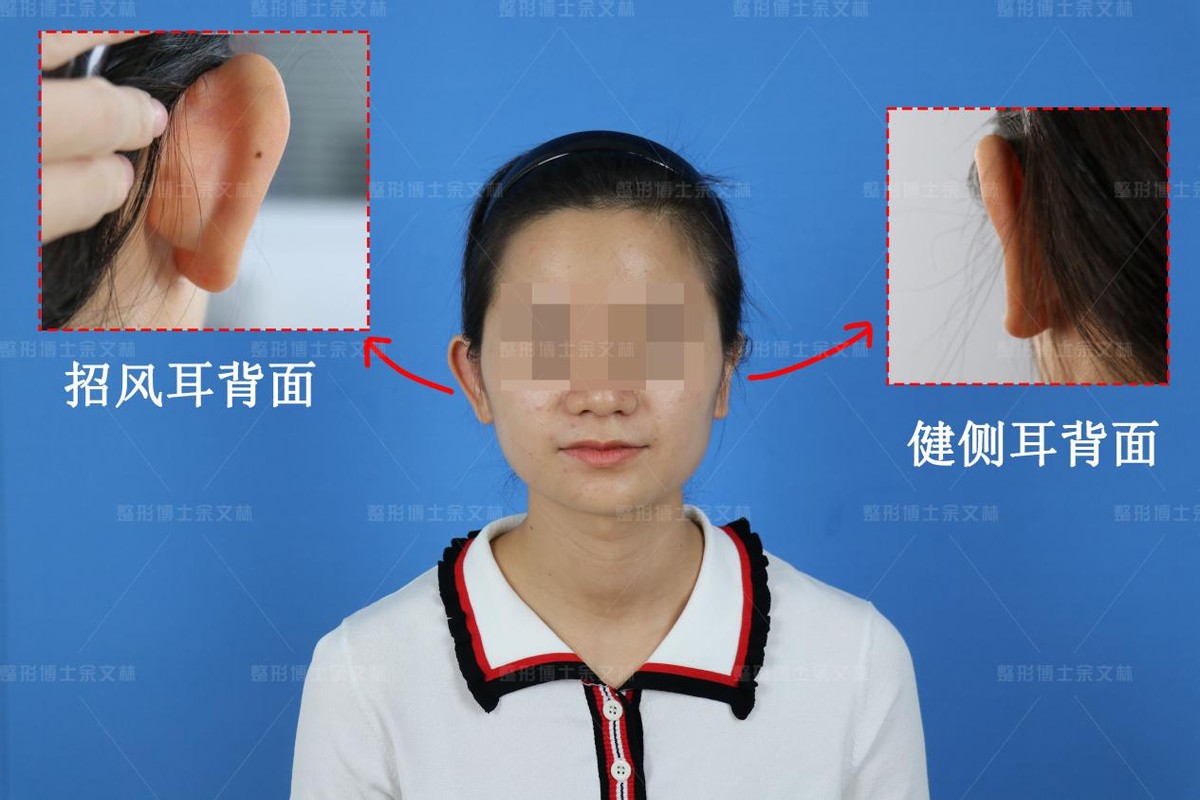 Can unilateral wind-induced ears be corrected to be the same as the ...