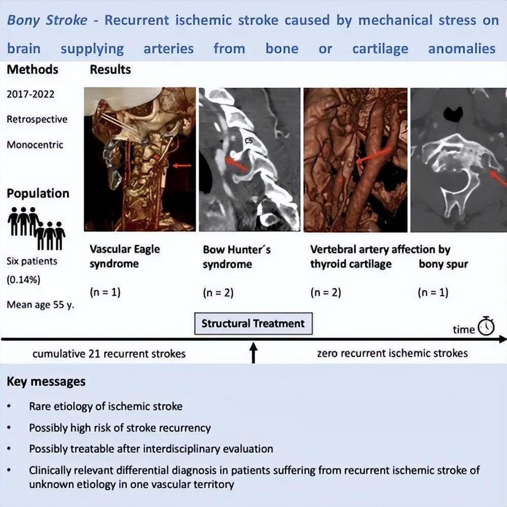 'Bone' stroke: Bone defect can lead to recurrent stroke - iNEWS