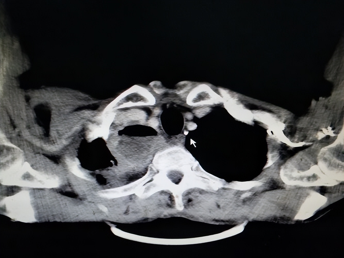 Is it harmful to the body to do a CT scan? Can CT cause cancer? doctor ...