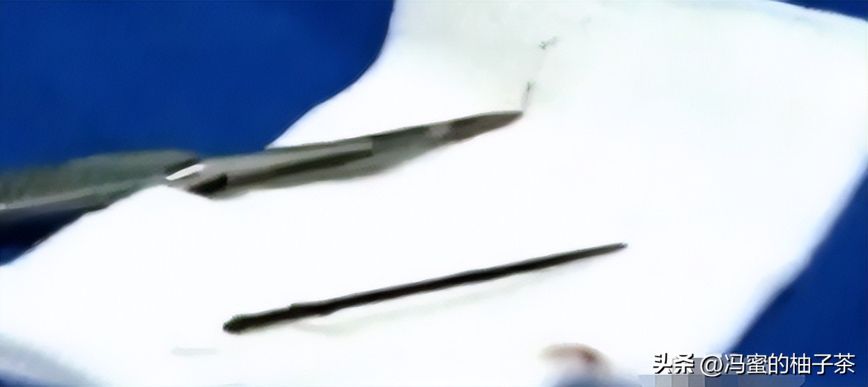 In 2004, 26 sewing needles were found in the body of the peasant woman ...