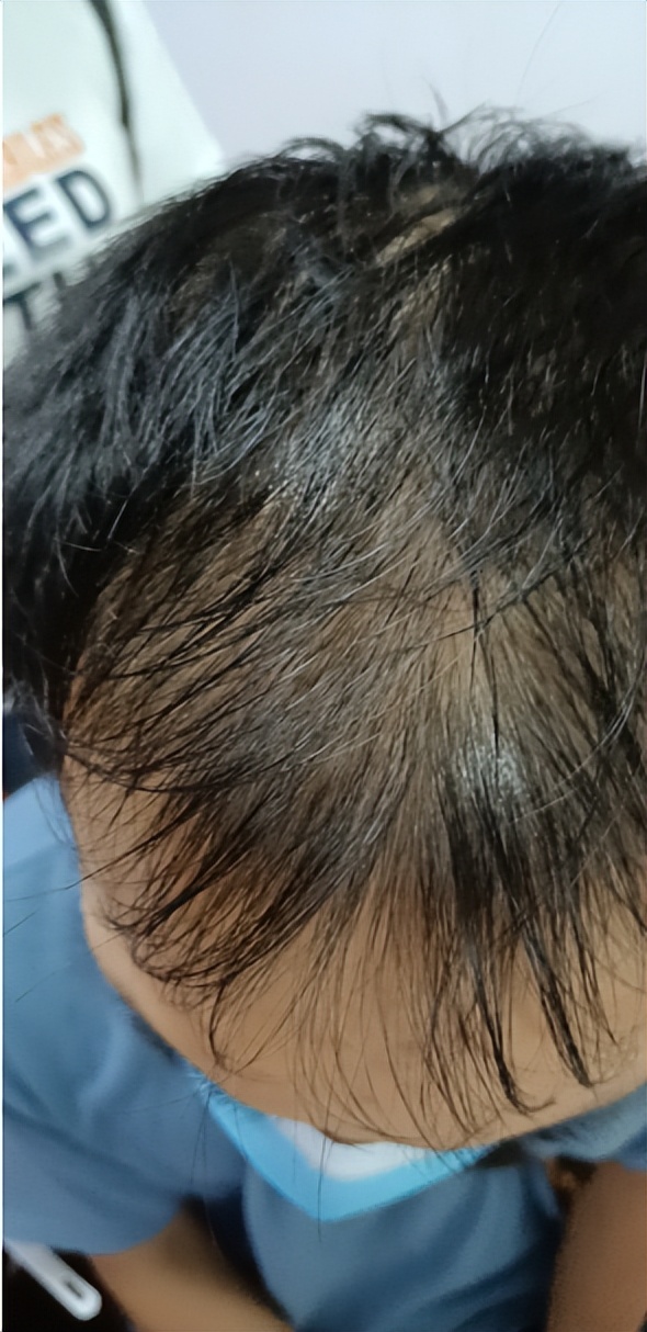 19-year-old boy's hair loss, doctors find the root cause!The medicine ...