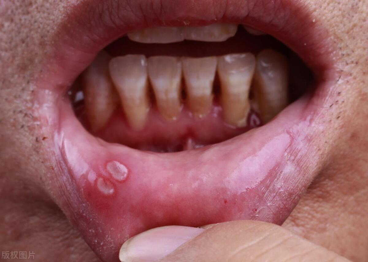 Xue Lizhai's medical case: Often get angry and cause oral ulcers, in ...