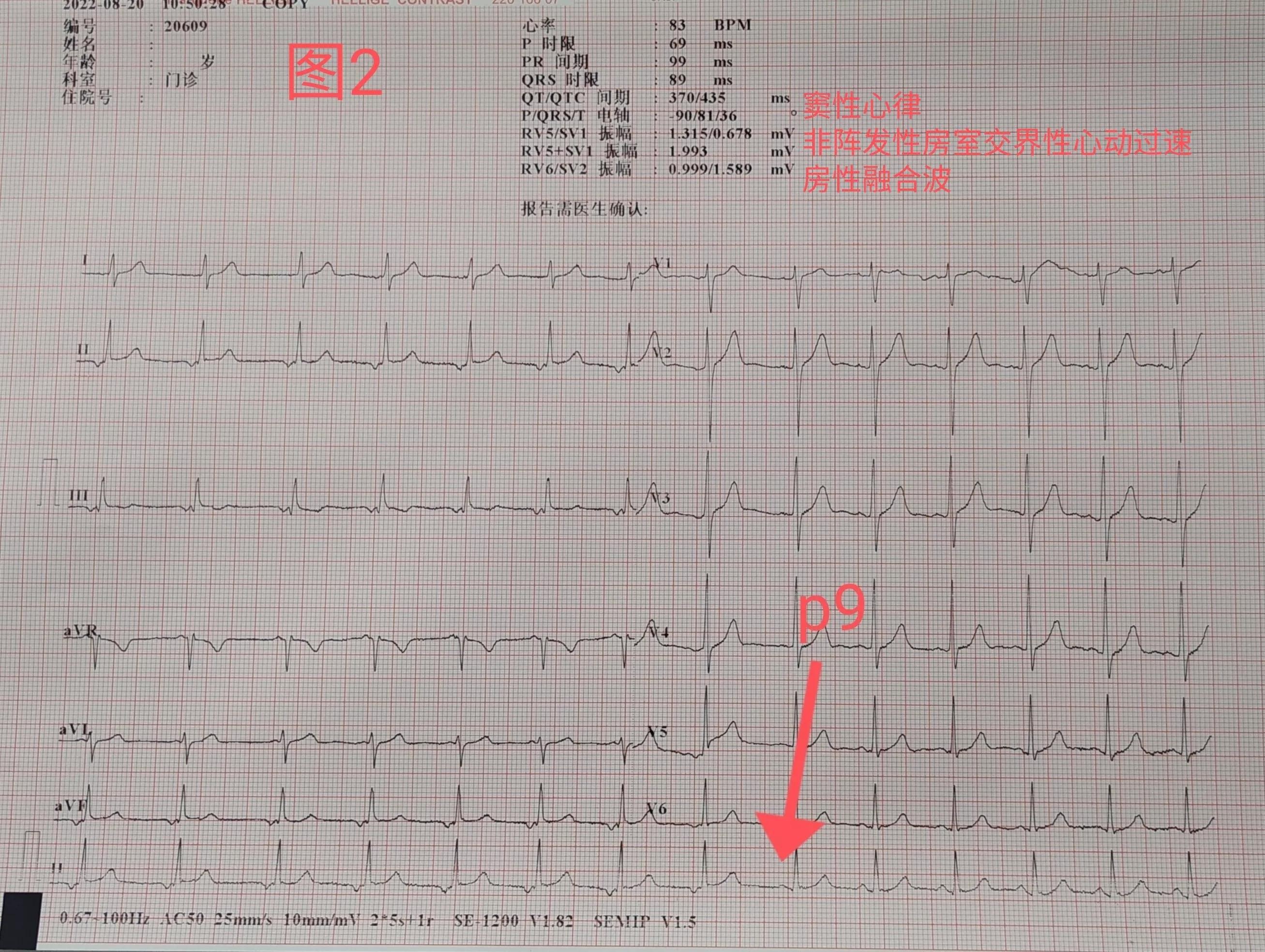 non-paroxysmal atrioventricular junctional tachycardia - iNEWS