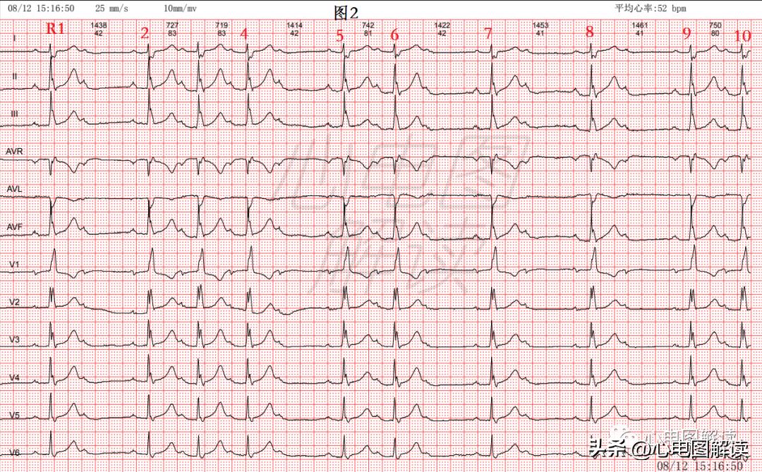 Complex and variable second-degree atrioventricular block, right bundle ...