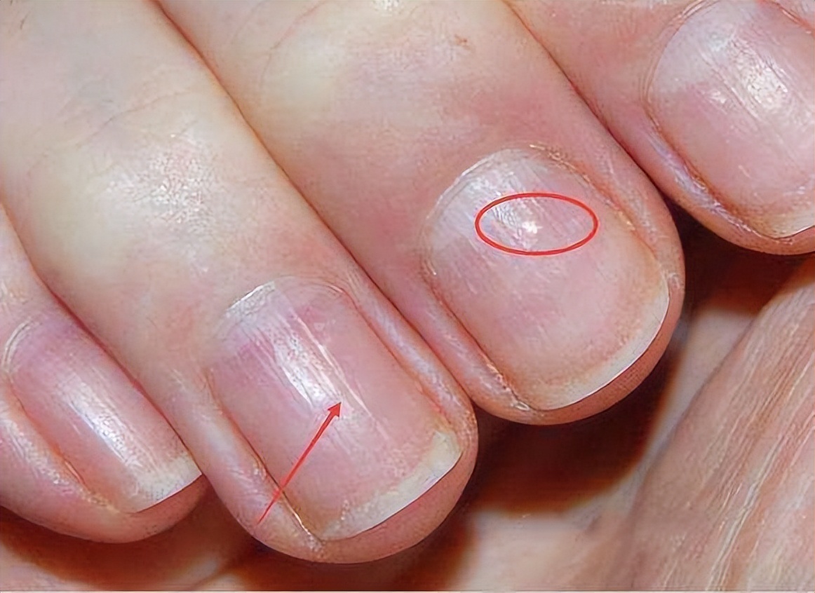 There are vertical lines on the nails, what is the cause? Is it the old ...