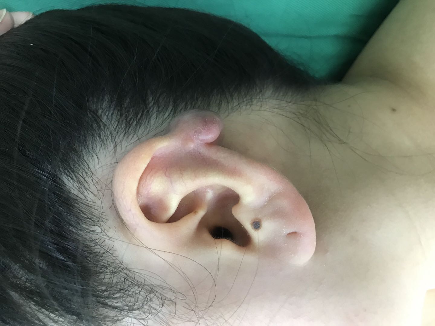 How to get rid of pimples on ears? - iNEWS