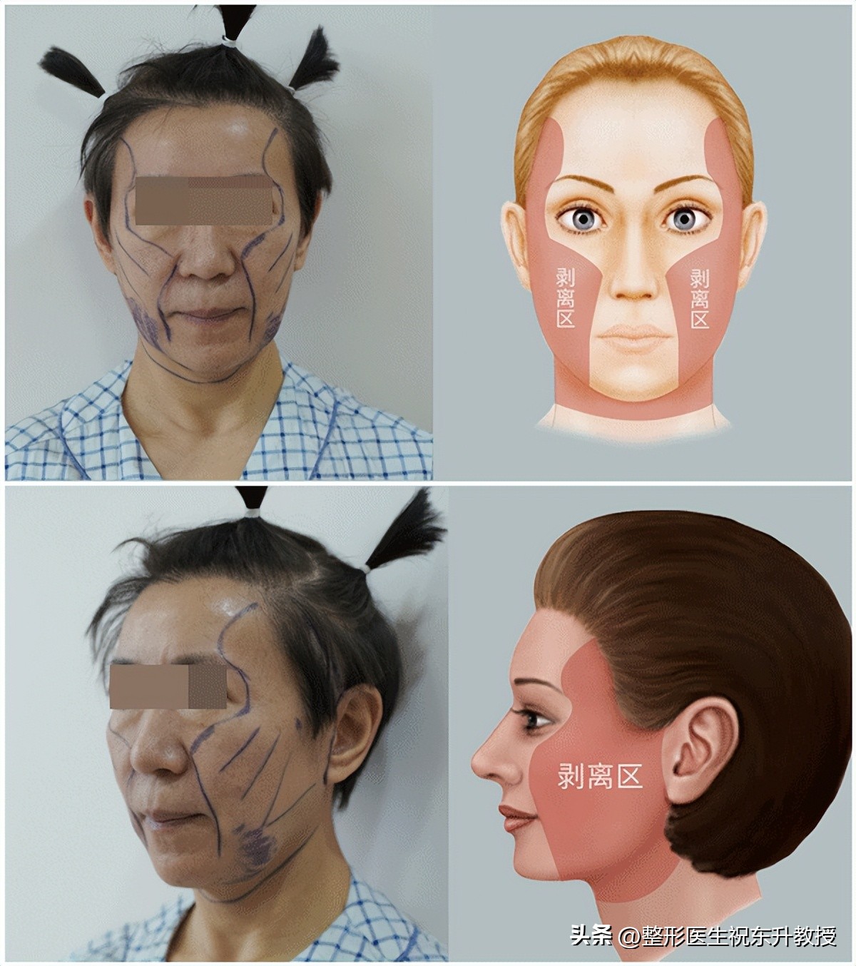 Why are the edges of the eyes, nose, and mouth peeled off during ...