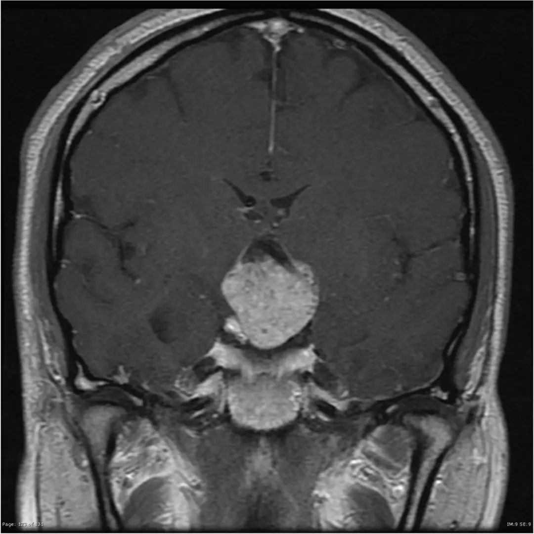 Imaging Diagnosis Notes-Intracranial Teratoma - iMedia