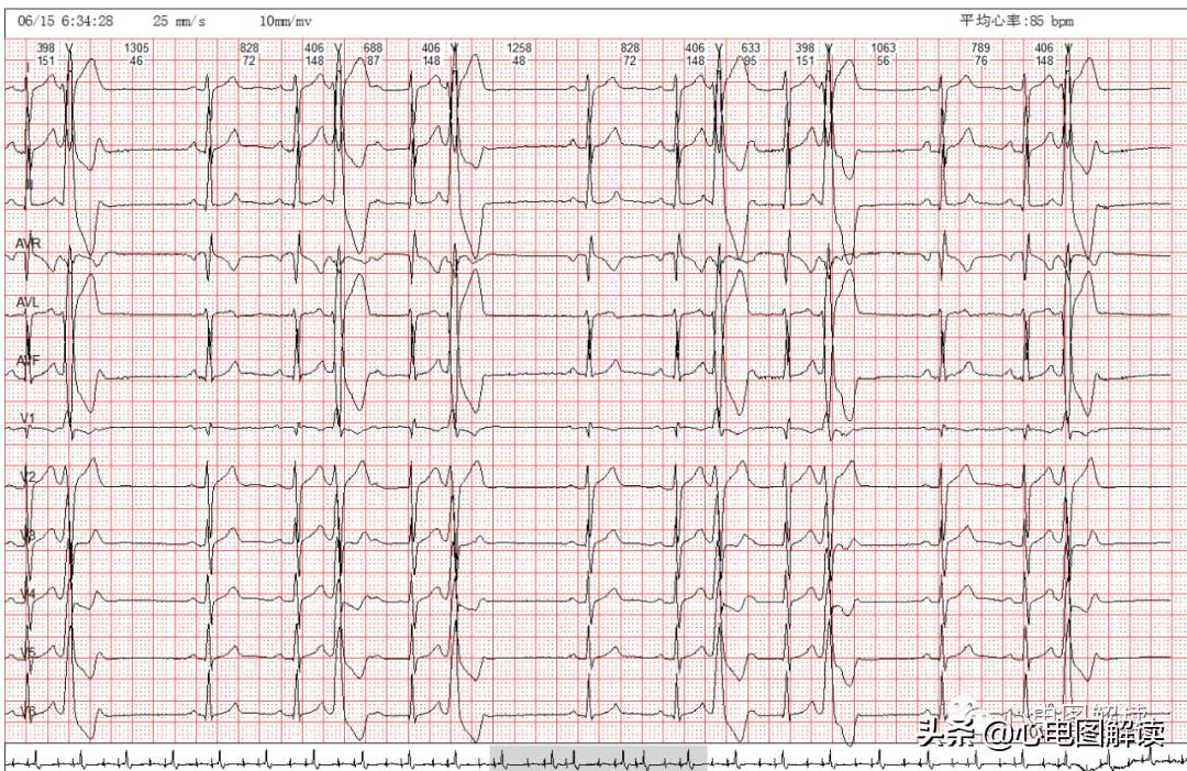 Intrusive premature ventricular contractions cause several consecutive ...