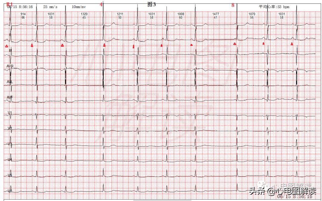 (brady) junctional escape beat (heart rhythm) and one of its causes - iNEWS