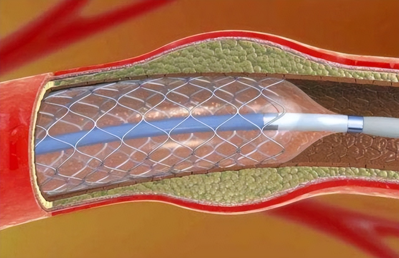 How many years can you live with a heart stent?The doctor revealed the ...