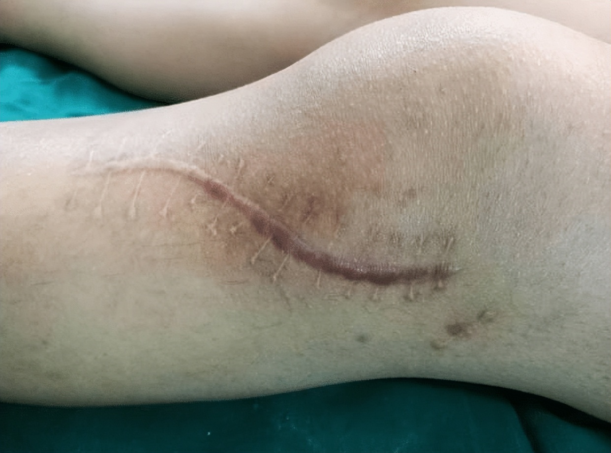 Often low back pain, actually because of a scar - iMedia