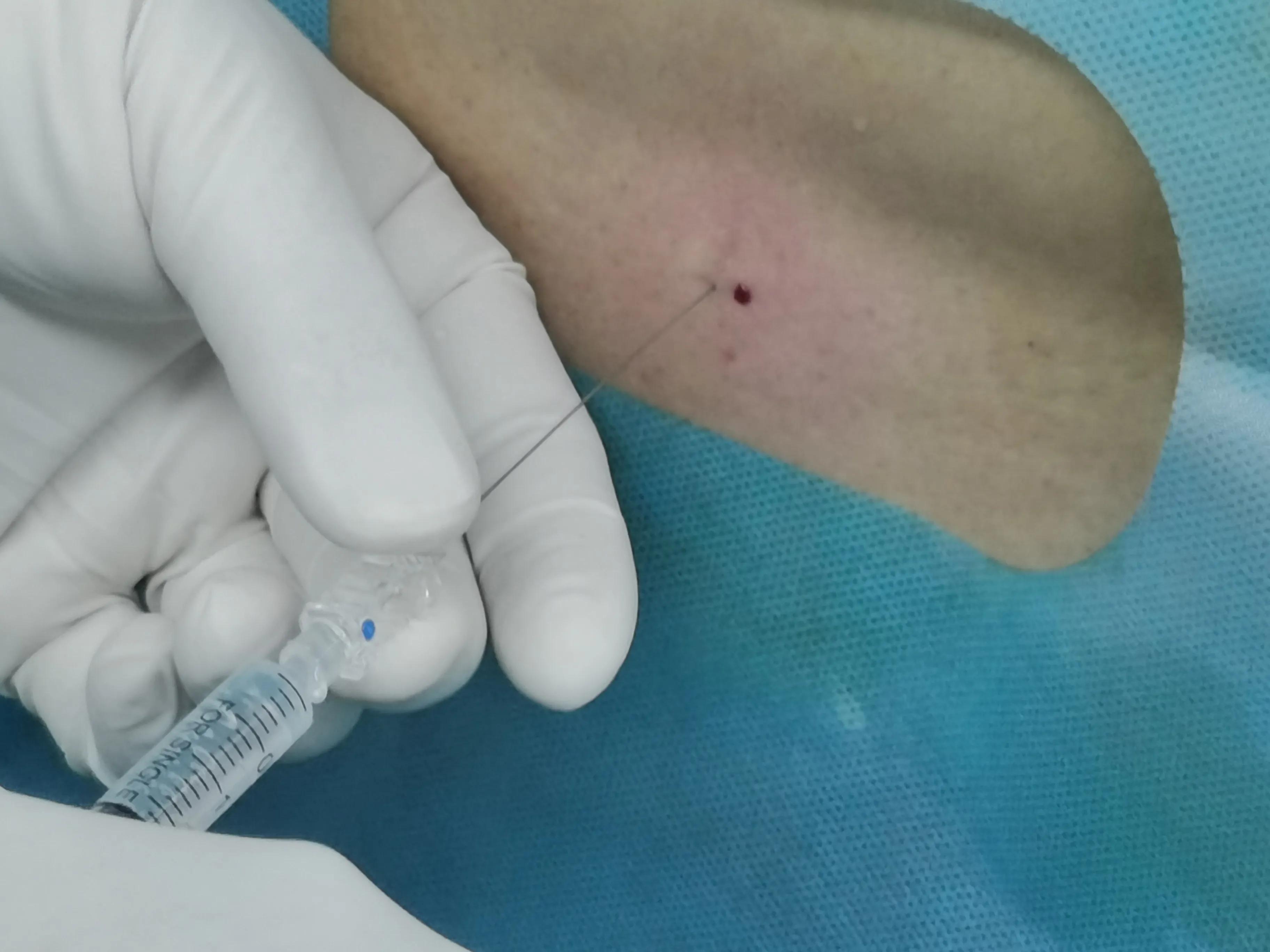 Do I need to lie down on a pillow after spinal anesthesia?should keep ...