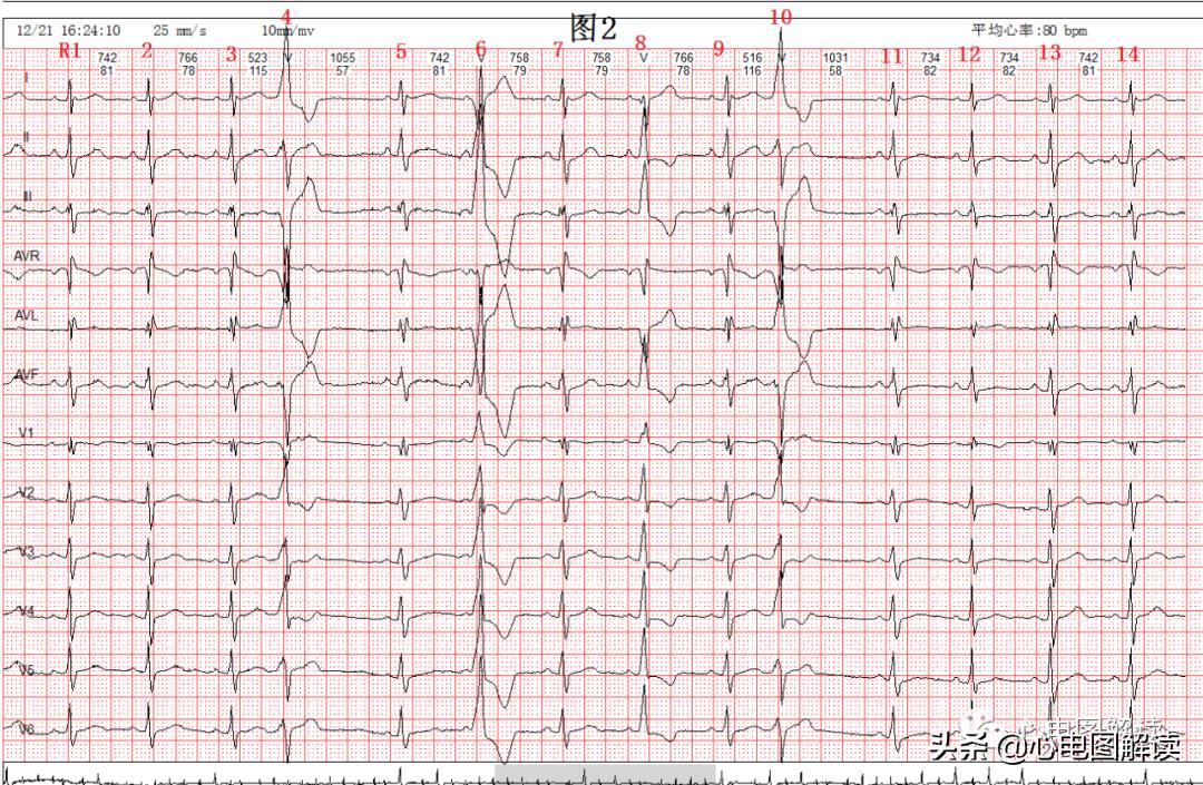 Non-sustained ventricular tachycardia, premature ventricular ...