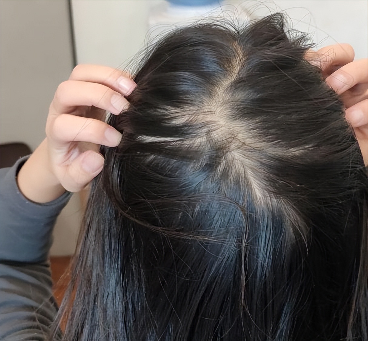 Sparse on the top of your head and still love hair loss?Teach you how ...