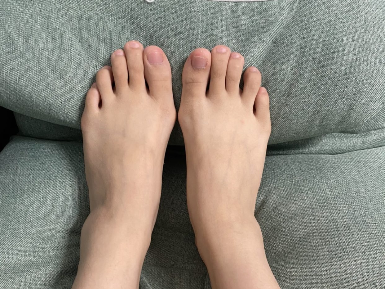 Hallux valgus develops gradually, difference between young hallux ...