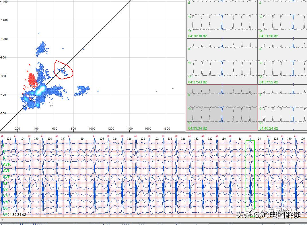 Atrial flutter, premature ventricular contractions, scatter plot - iNEWS