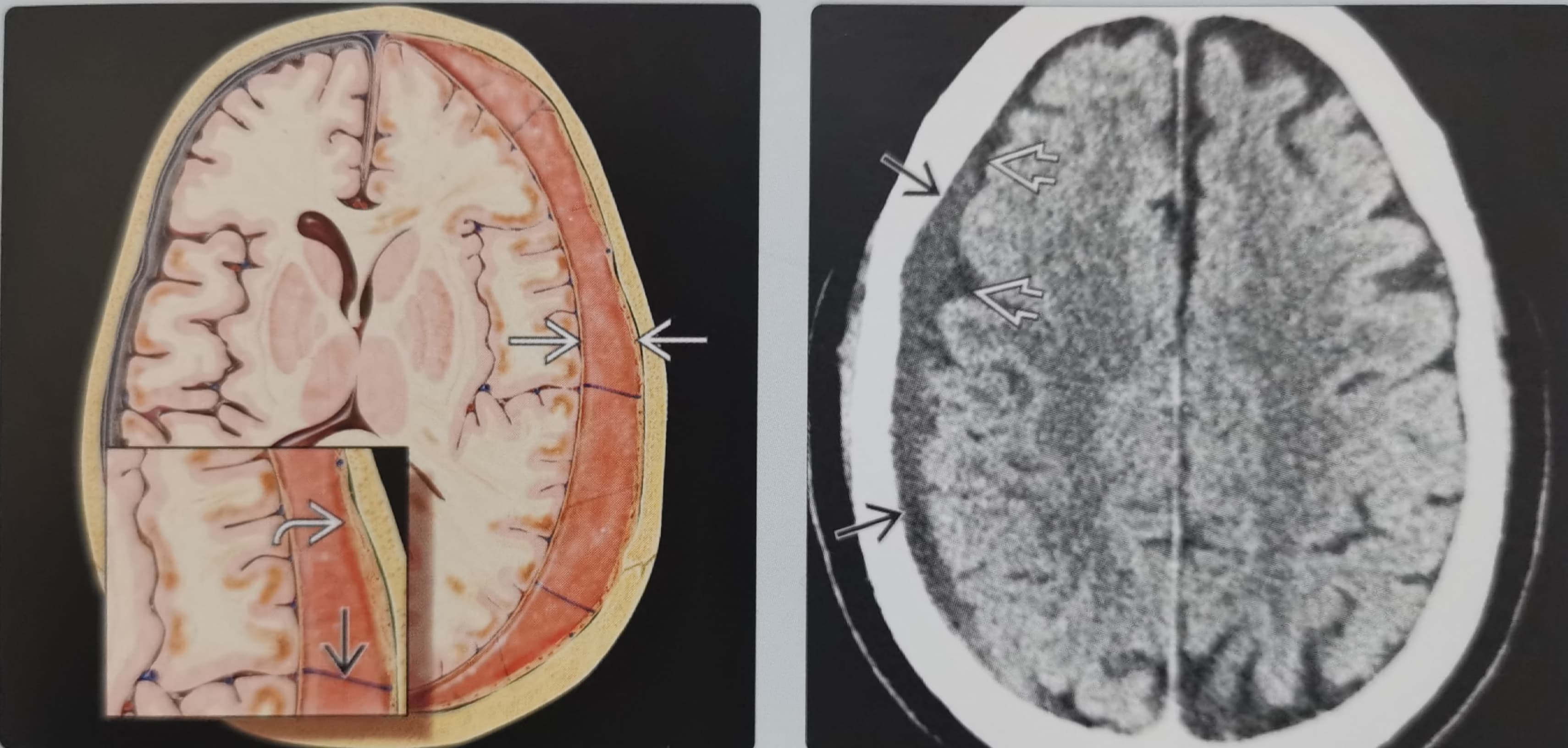 Subdural Hematoma—Key Points of Imaging Diagnosis and Classification ...
