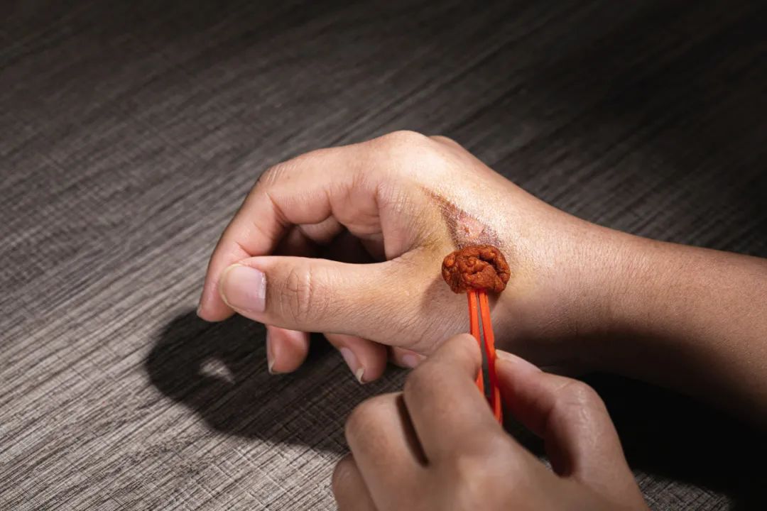 What to do if you don't want to leave a scar when you are injured?Learn ...