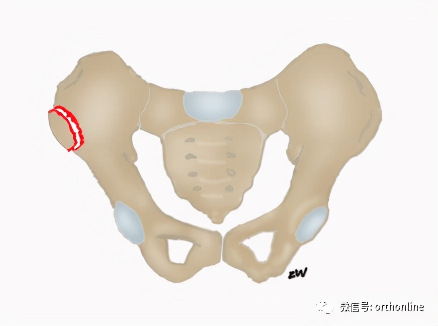 Tile classification of pelvic fractures - iNEWS
