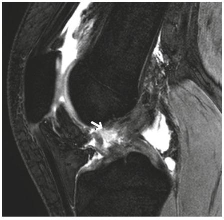 Confident Diagnosis - MRI ACL Torn - iNEWS