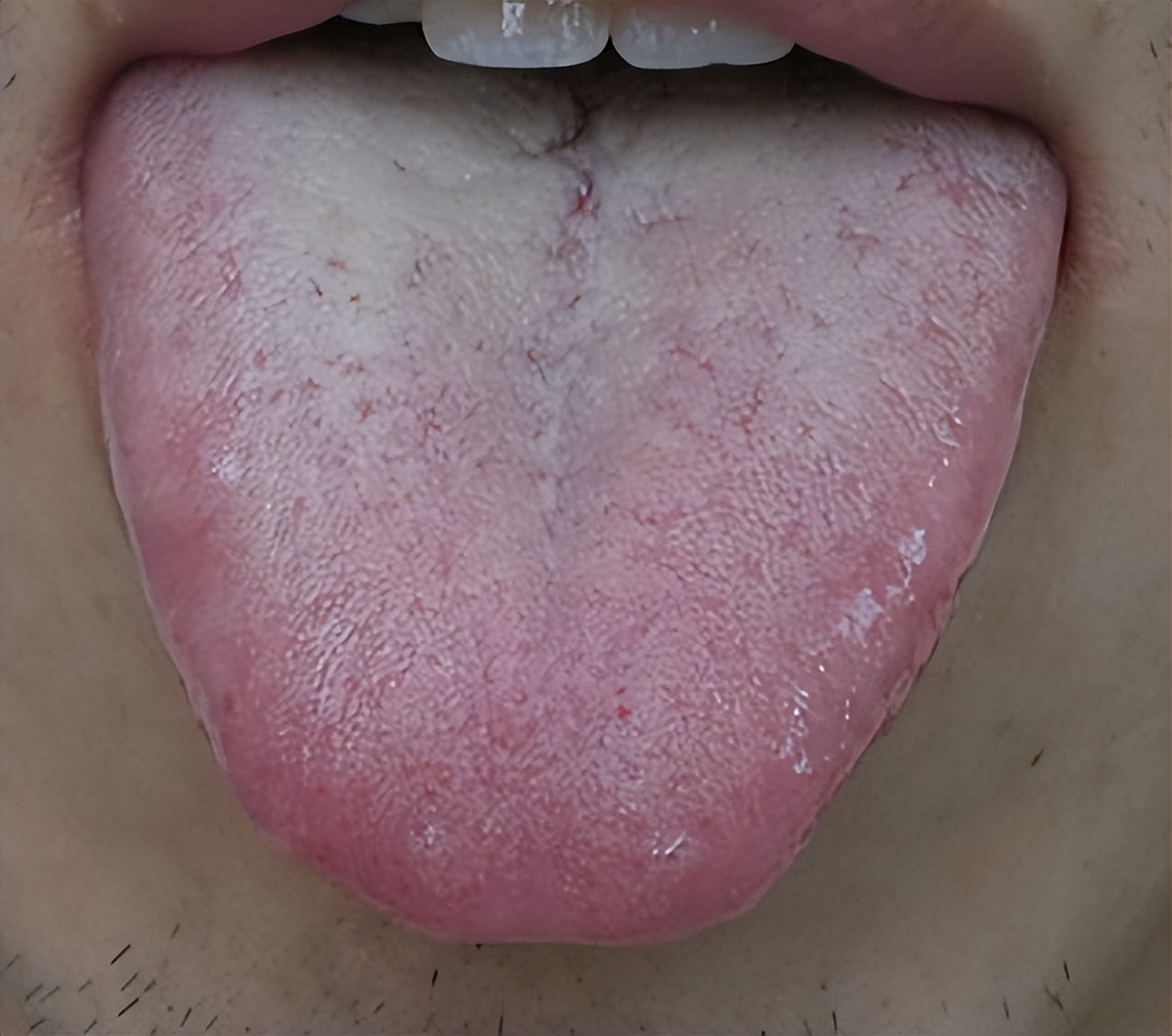 There are cracks at the base of the tongue, deficiency of both yin and ...