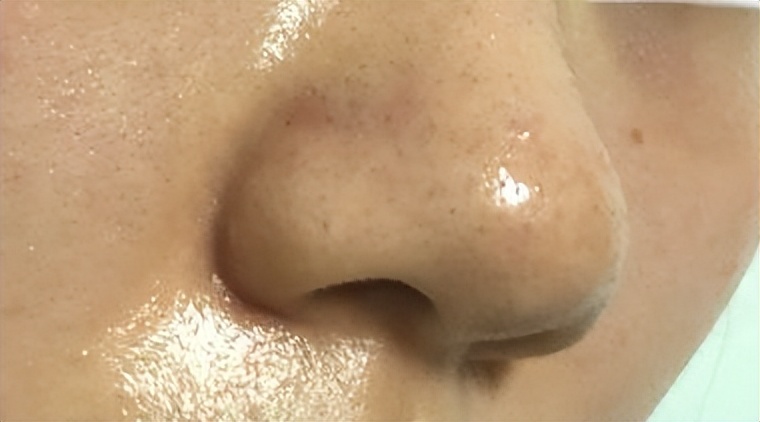 Oily nose in summer?There are 7 reasons other than heat - iNEWS