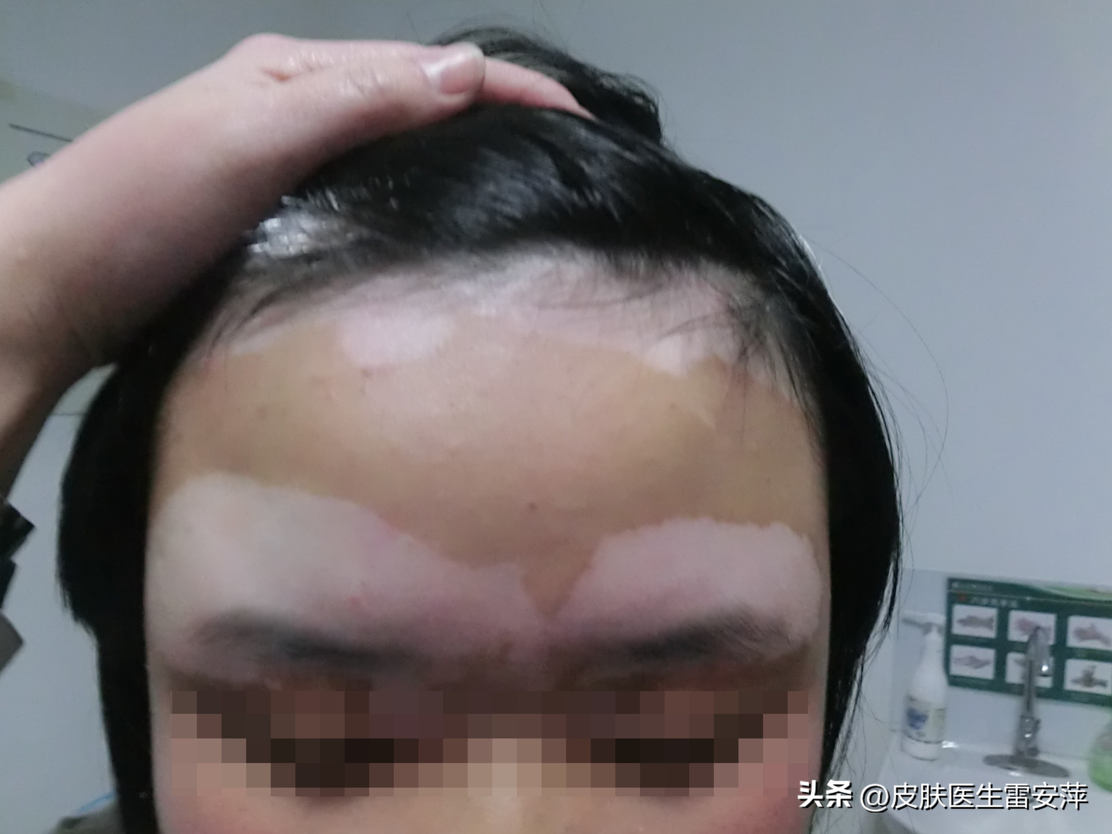 What should I do if Vitiligo develops into a large area?You can try ...