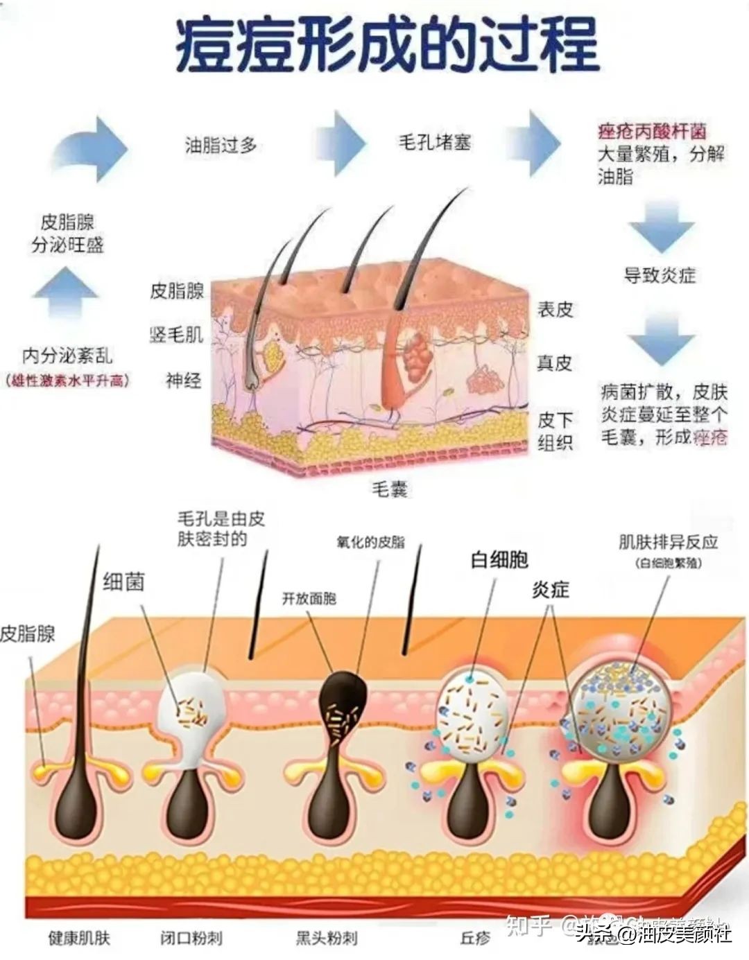 How to deal with oily skin and acne?How to save oily acne skin? - iNEWS