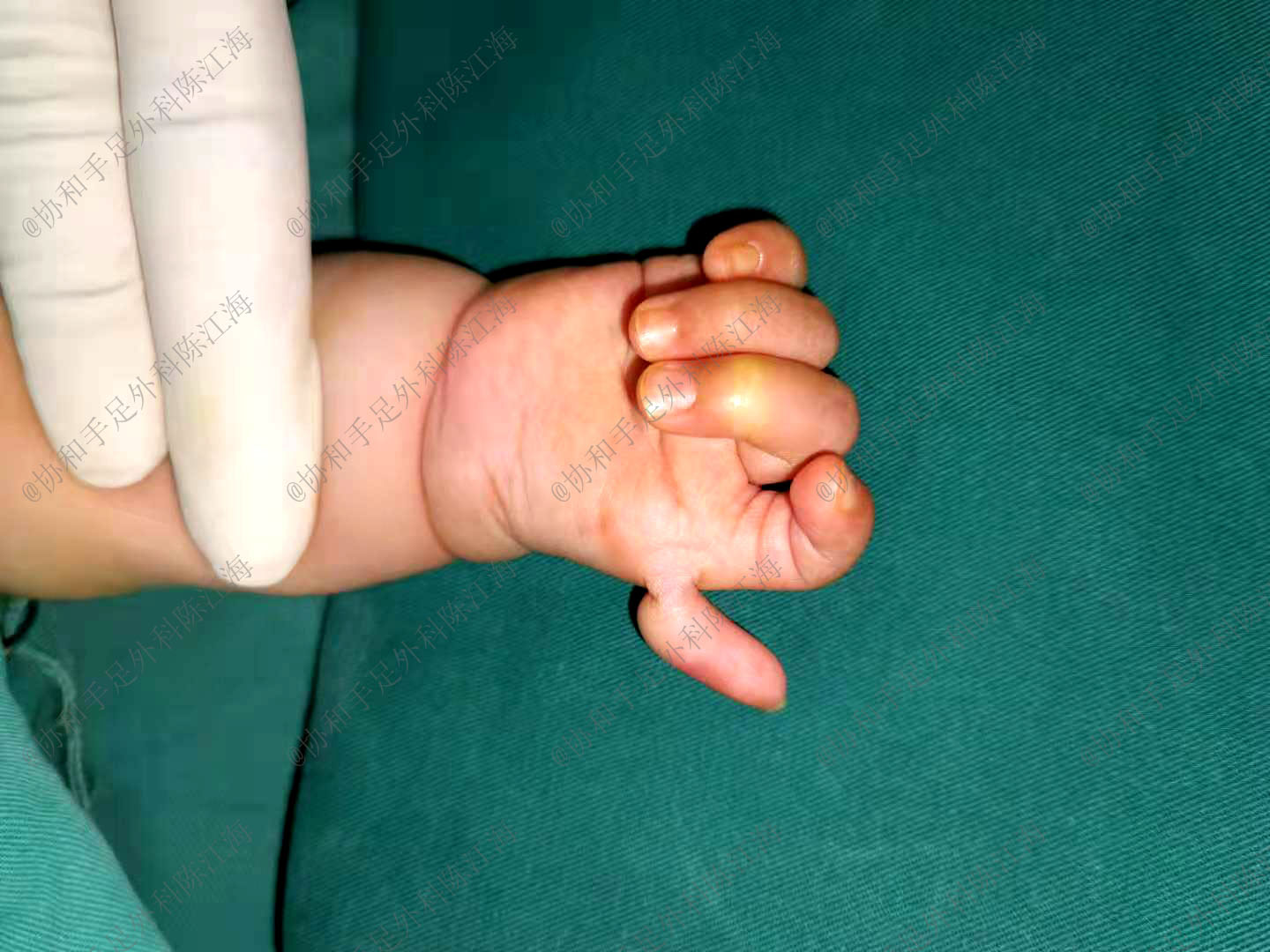 "My brother's hand is beautiful, I want to be the same as my brother's ...