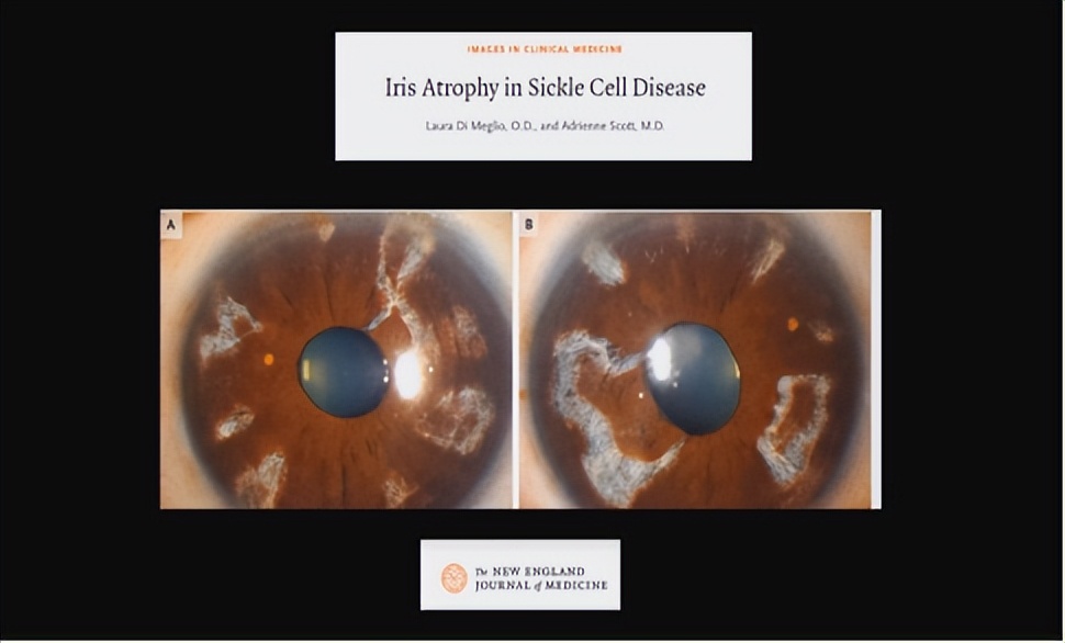 Sickle cell retinopathy: progress and breakthroughs - iNEWS