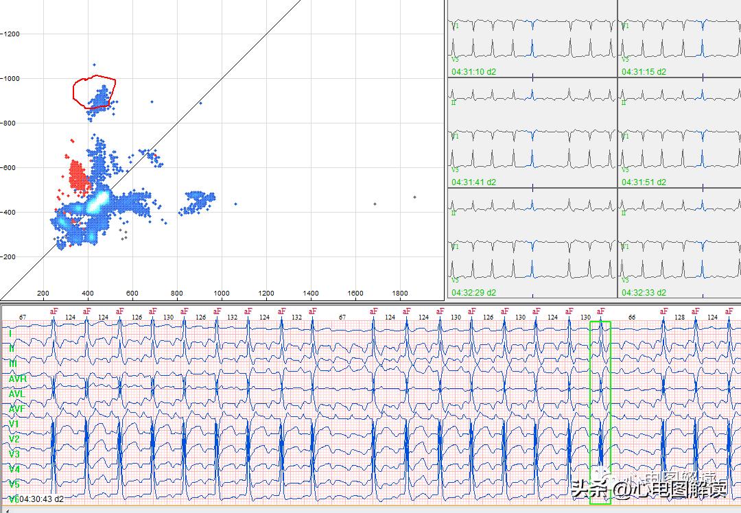 Atrial flutter, premature ventricular contractions, scatter plot - iNEWS