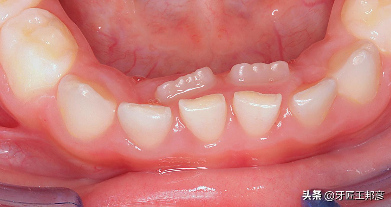 The child is about to replace his teeth. Should the decayed teeth be ...