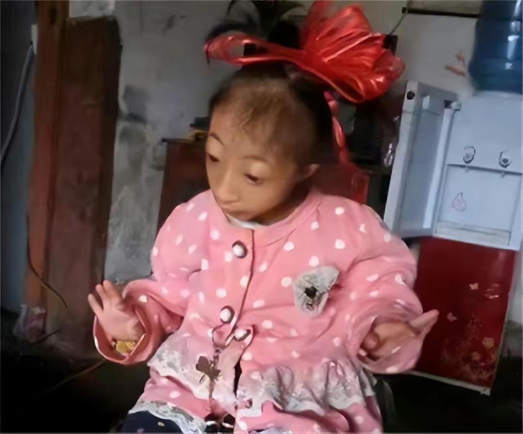 Pocket girl Liang Xiaoxiao: 2.1 kg at birth, 33 cm in length, stopped growing at the age of 3 ...