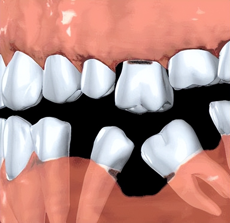 What are the effects of missing teeth? - iNEWS