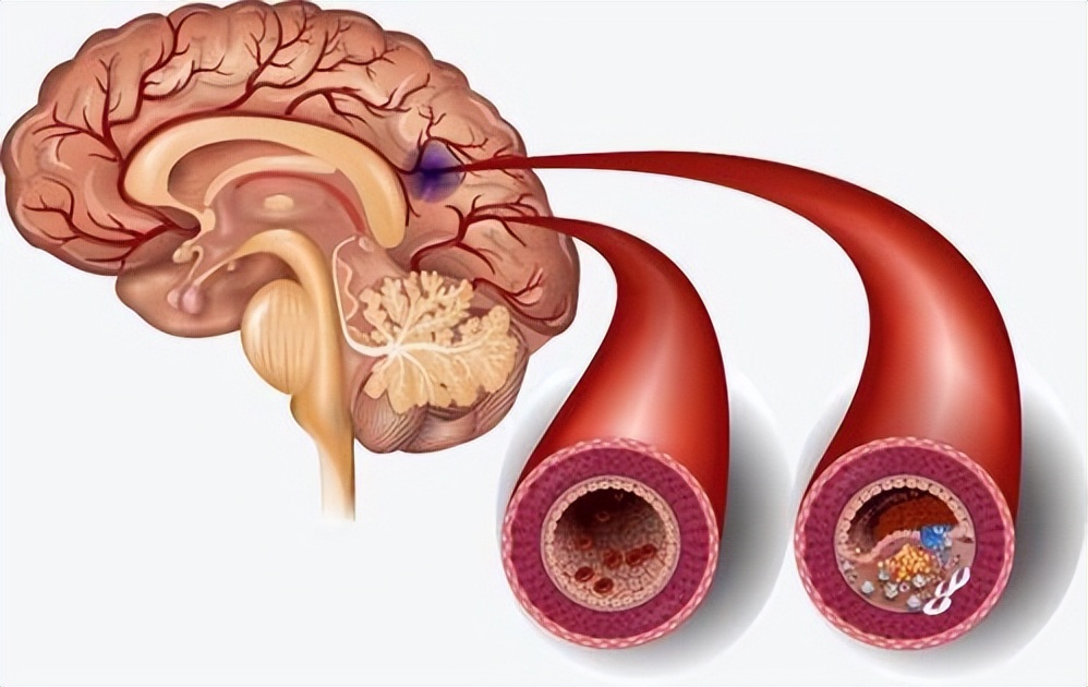 Two patients with myocardial infarction, one of them pricked their ...