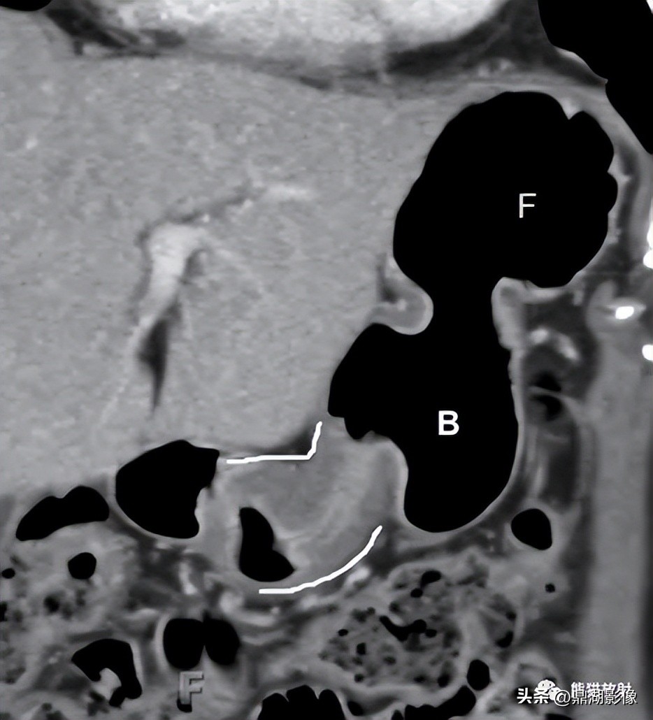 Acute gastric disease - iNEWS