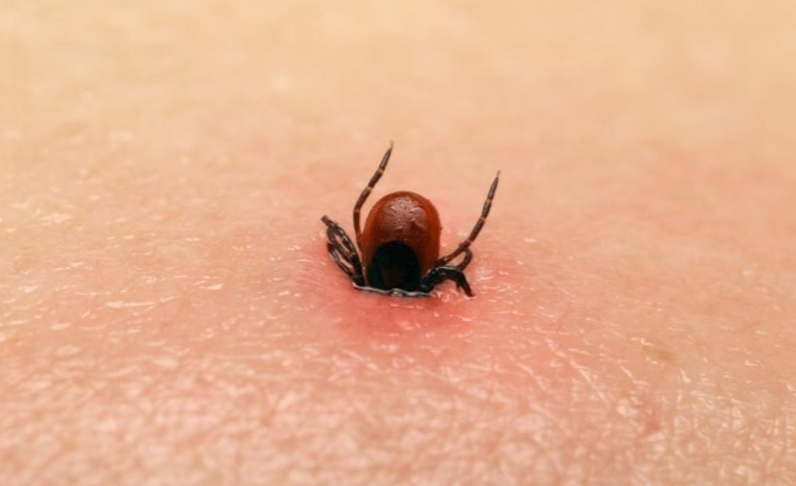 4-year-old child bitten by tick, mother's "4-step" treatment shows ...