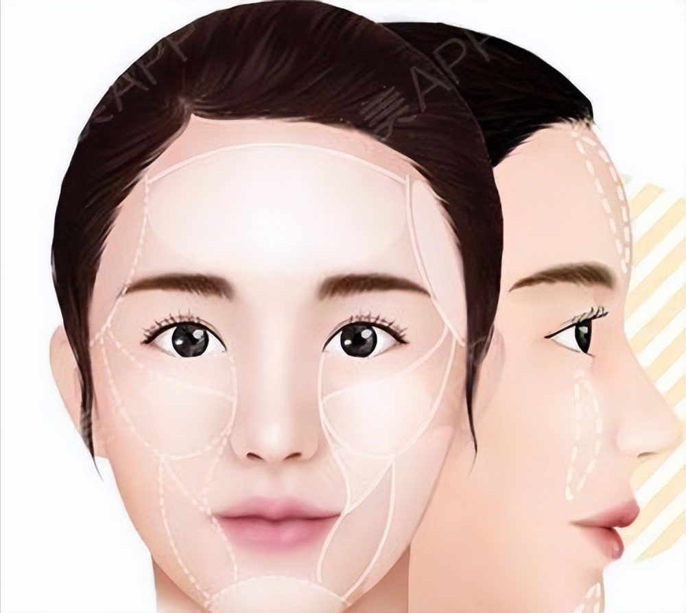 What are the precautions for autologous fat filling in the face? - iNEWS